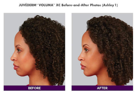 Juvederm Voluma for Chin Augmentation - Vedas Med Spa & Wellness Ctr