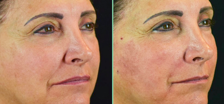 Skin Scaffolding - Vedas Medical Spa and Wellness Center