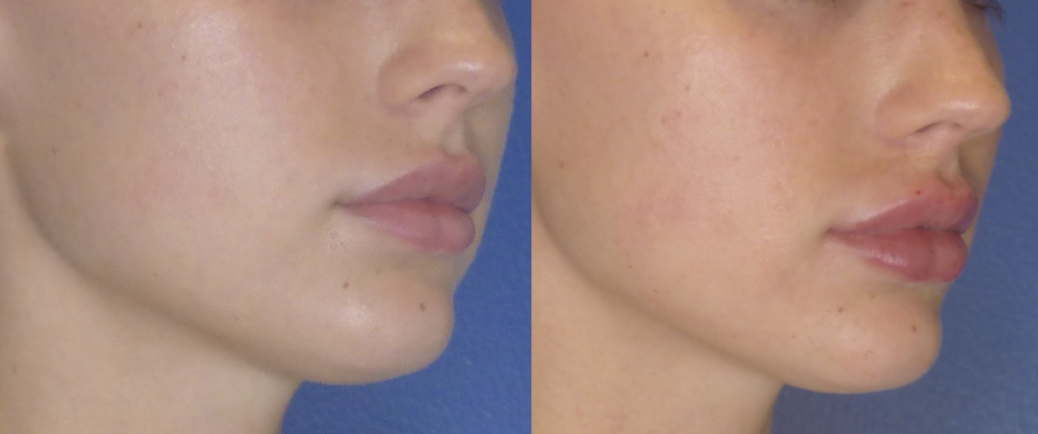 Botox Double Points! - Vedas Medical Spa and Wellness Center