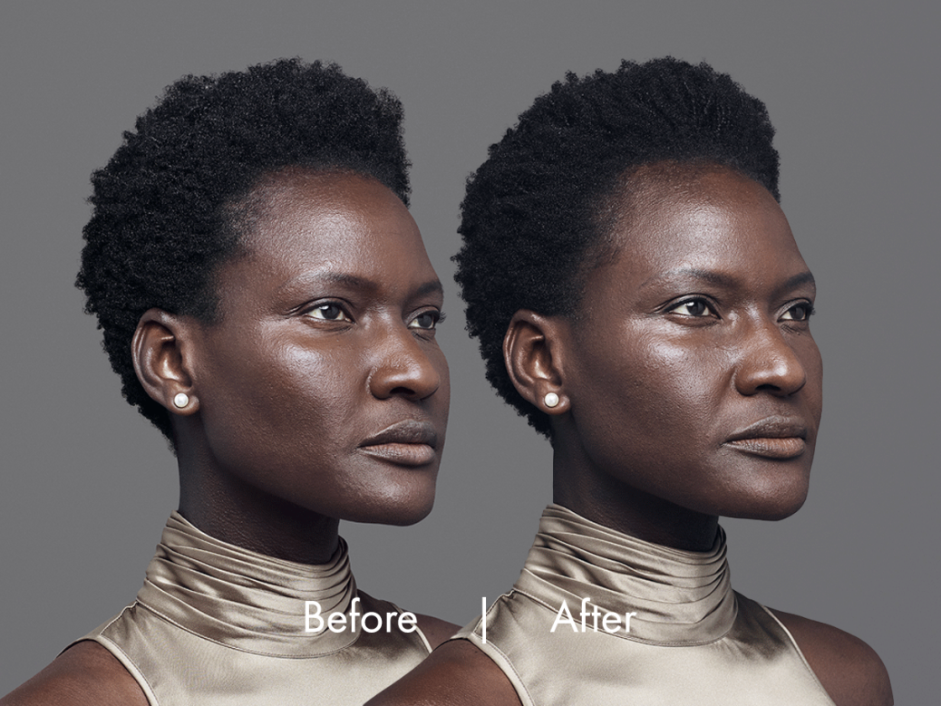 Resilient Hyaluronic Acid RHA Collection at Vedas Medical Spa